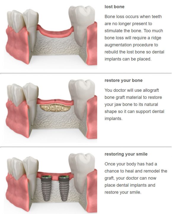 Ridge Augmentation - North Hills Periodontics
